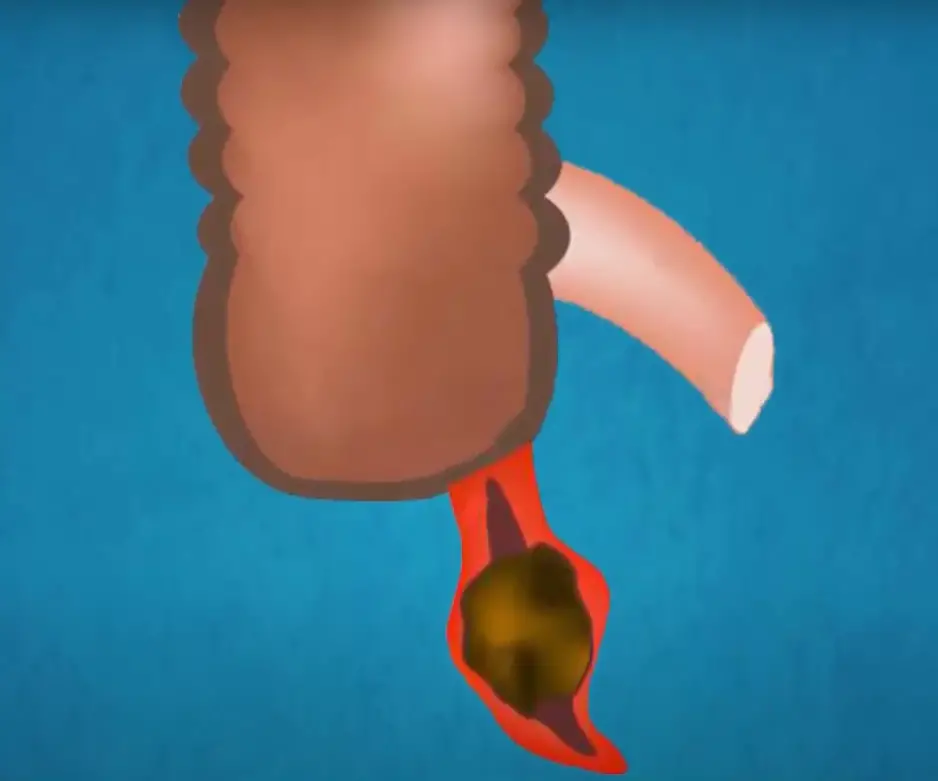 Appendix Stones (Appendicolith): Incidence, Causes, Symptoms ...