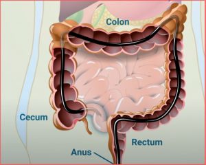 How Far Does Colonoscopy Go? - Oh My Gut