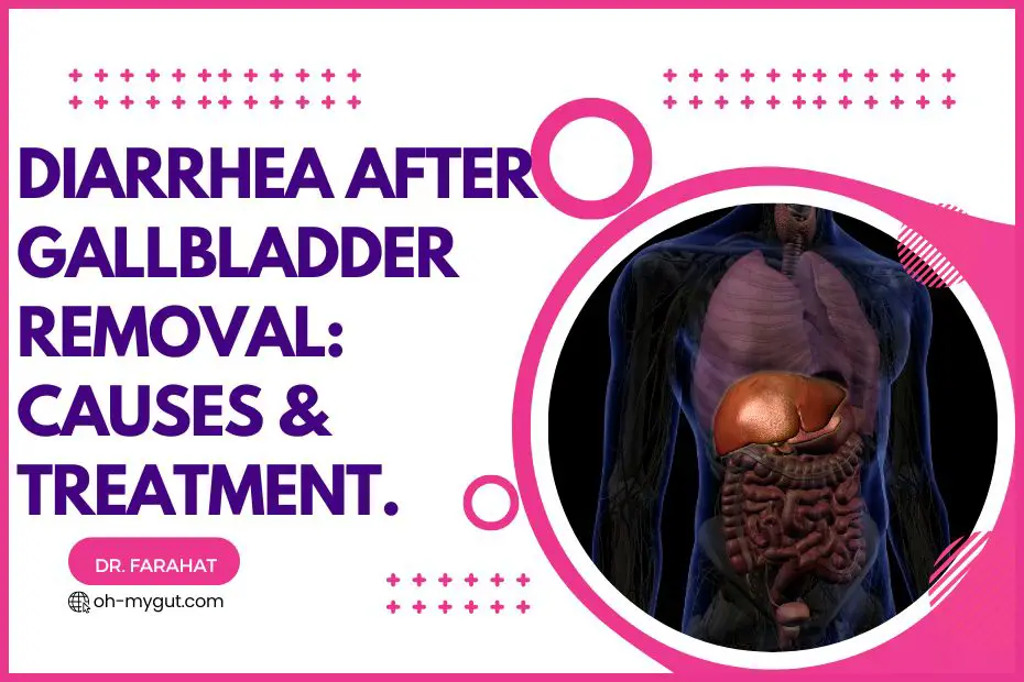 6 Problems After Gallbladder Removal, Years Later (Dr. Farahat) - Oh My Gut